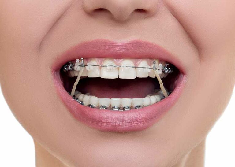 Elastics at Taylor Orthodontics in Tustin Ladera Ranch CA